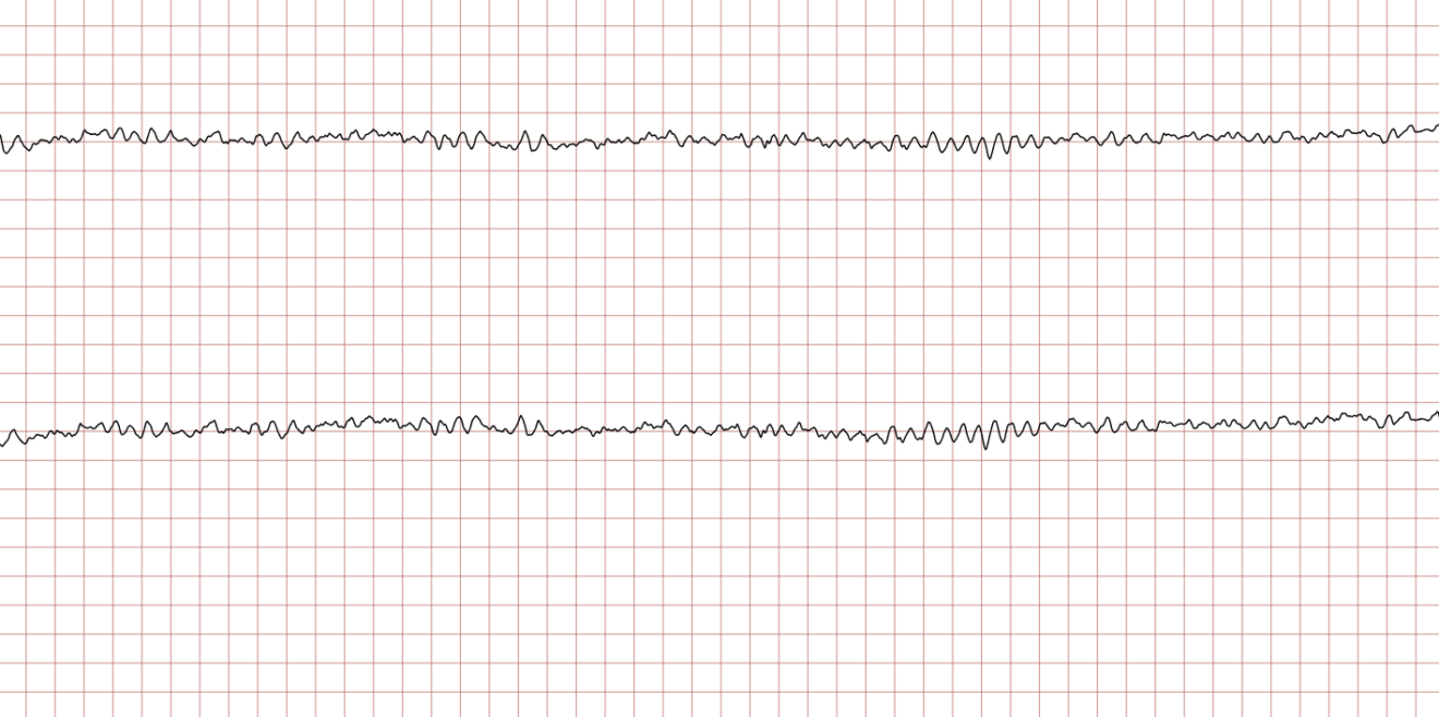 Fibrillation ventriculaire, activité électrique sans pouls et arrêt ...