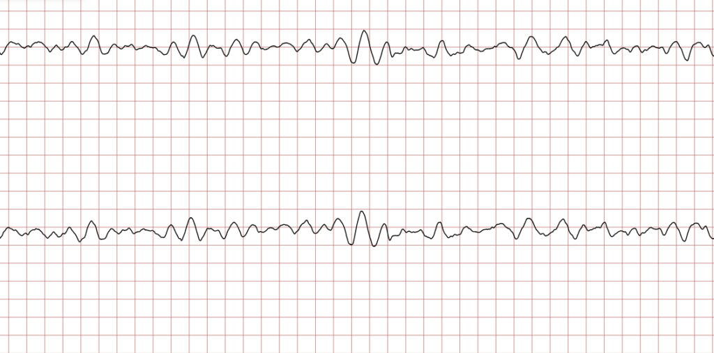 Fibrillation ventriculaire, activité électrique sans pouls et arrêt ...