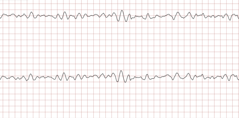 Fibrillation ventriculaire, activité électrique sans pouls et arrêt ...