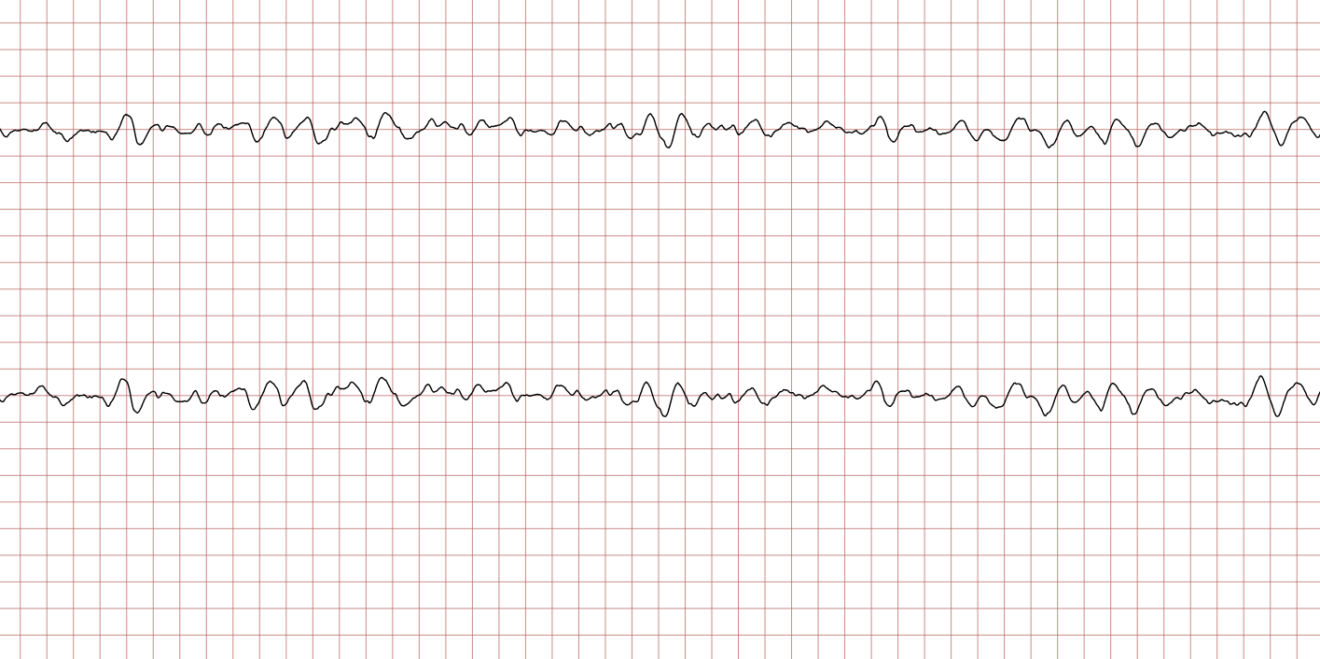 Fibrillation ventriculaire, activité électrique sans pouls et arrêt ...