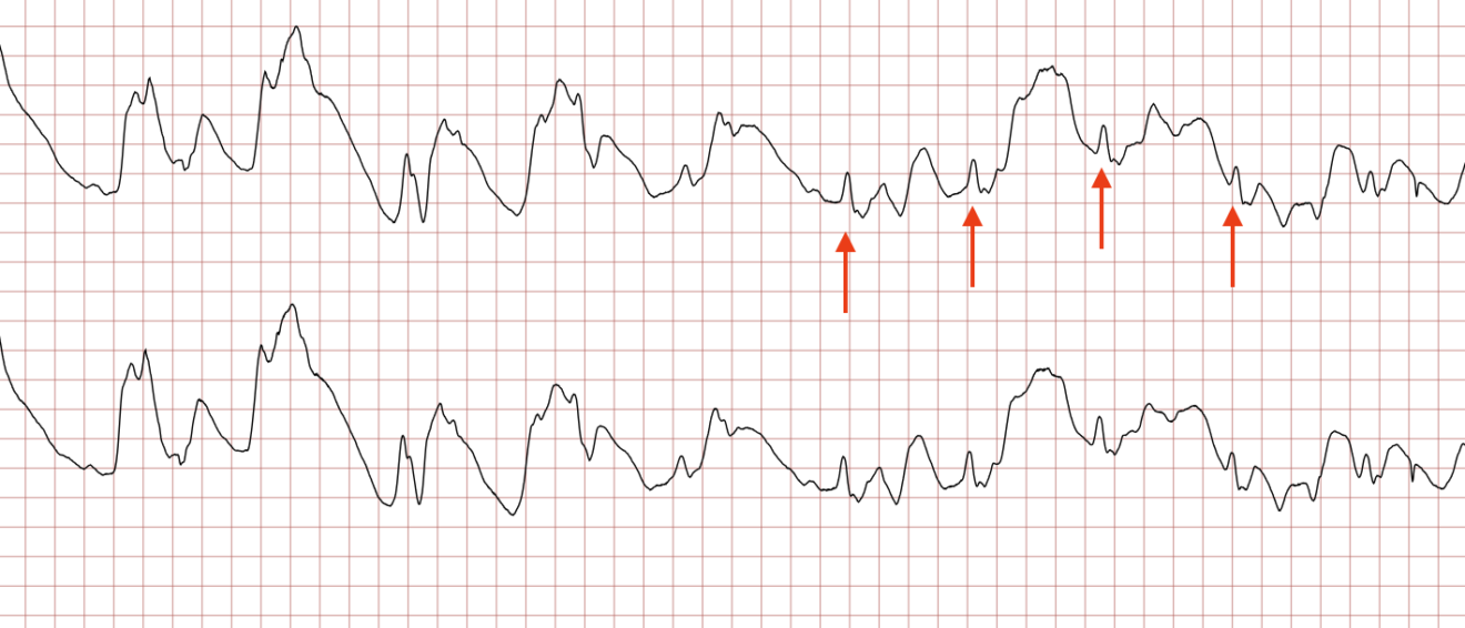Fibrillation ventriculaire, activité électrique sans pouls et arrêt ...