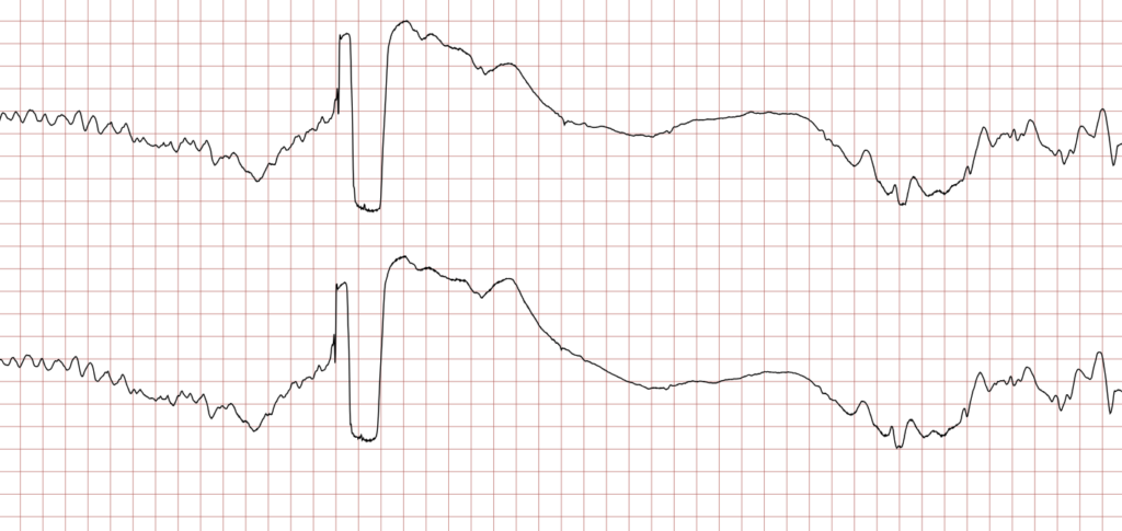 Fibrillation ventriculaire, activité électrique sans pouls et arrêt ...