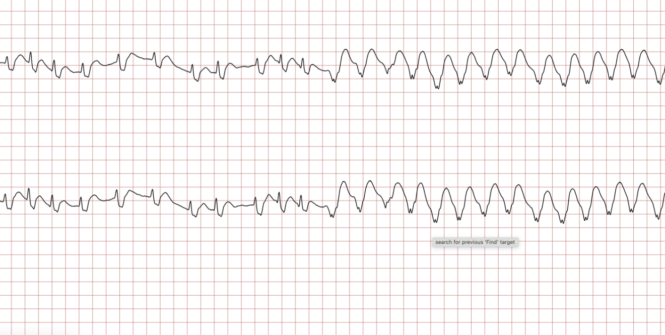 Fibrillation ventriculaire, activité électrique sans pouls et arrêt ...