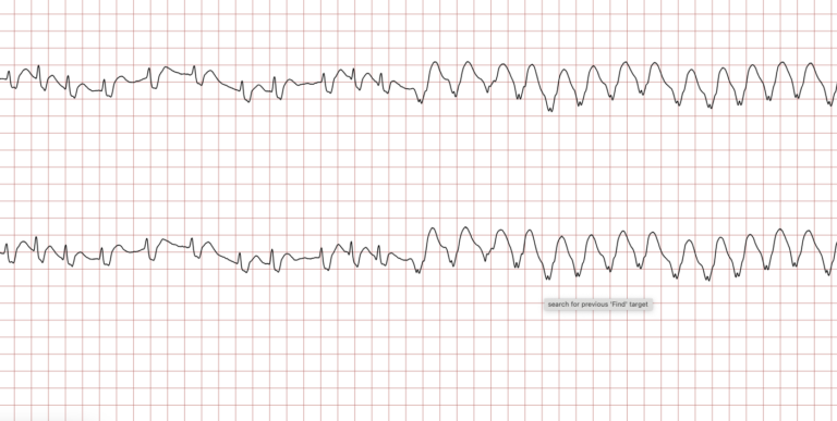 Fibrillation ventriculaire, activité électrique sans pouls et arrêt ...