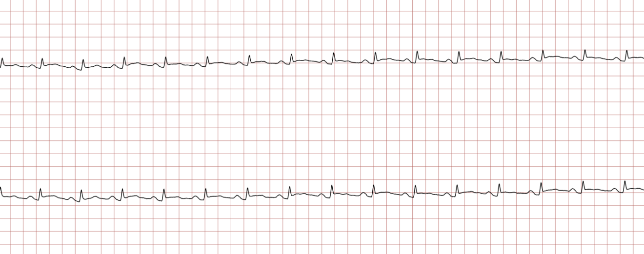 Fibrillation ventriculaire, activité électrique sans pouls et arrêt ...